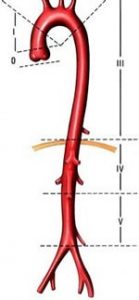 ANÉVRISME DE L’AORTE – Service de chirurgie thoracique et ...
