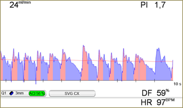 PONTAGE CORONAIRE – Service de chirurgie thoracique et cardiovasculaire ...