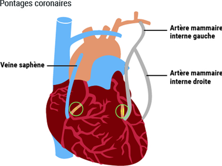 PONTAGE CORONAIRE – Service de chirurgie thoracique et cardiovasculaire ...